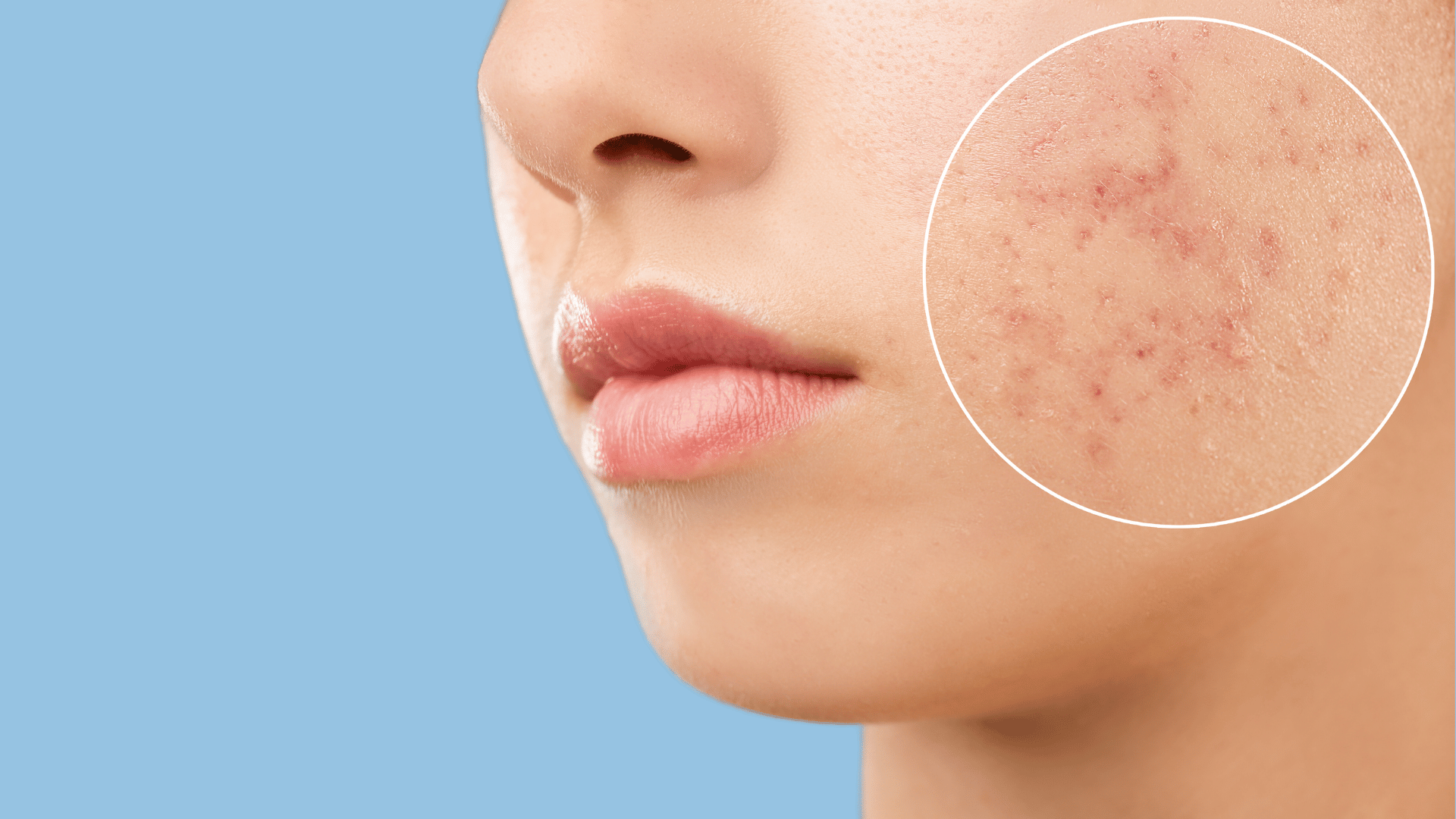 Acne Clinic In San diego